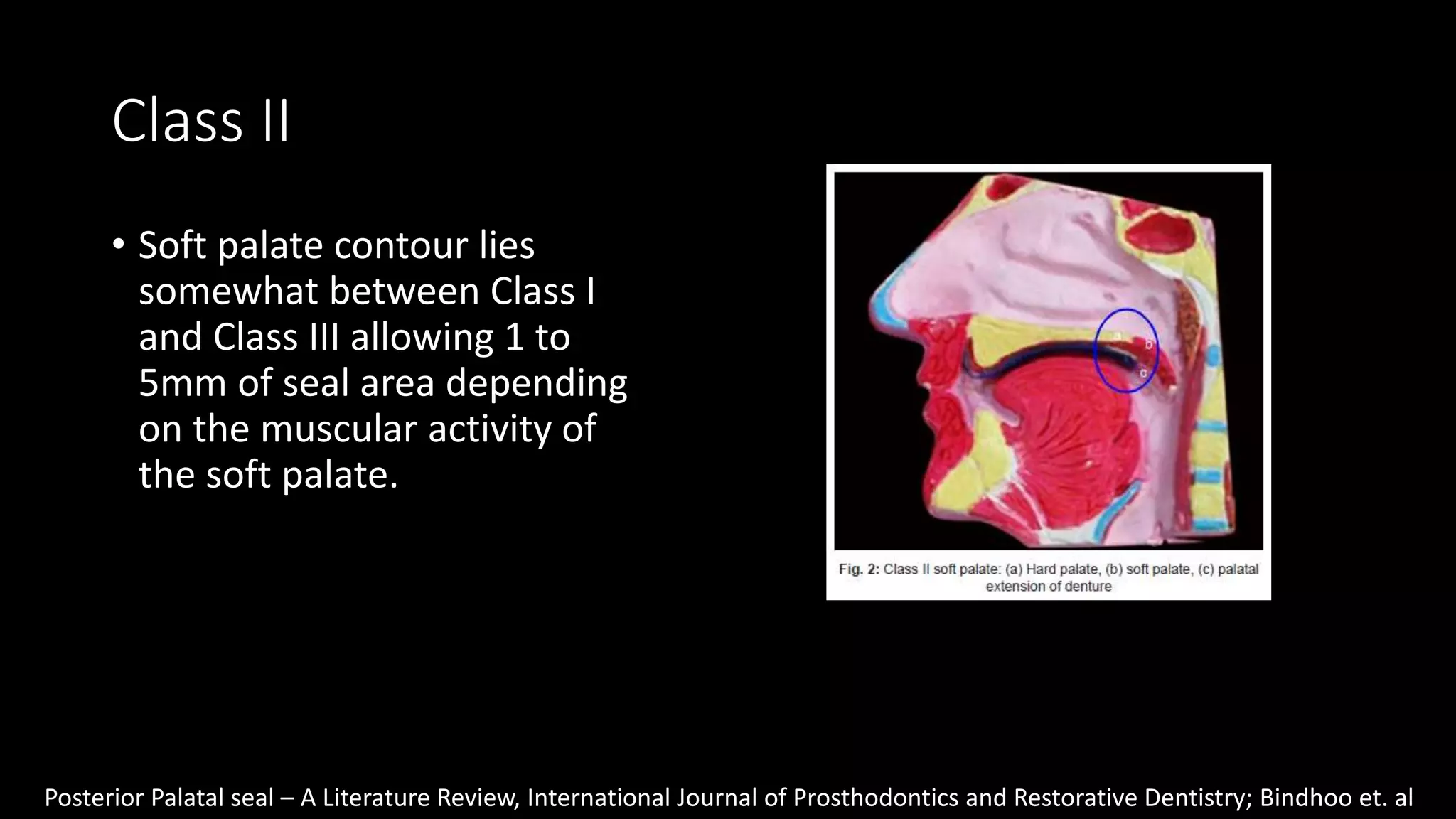 Posterior Palatal Seal | PPTX