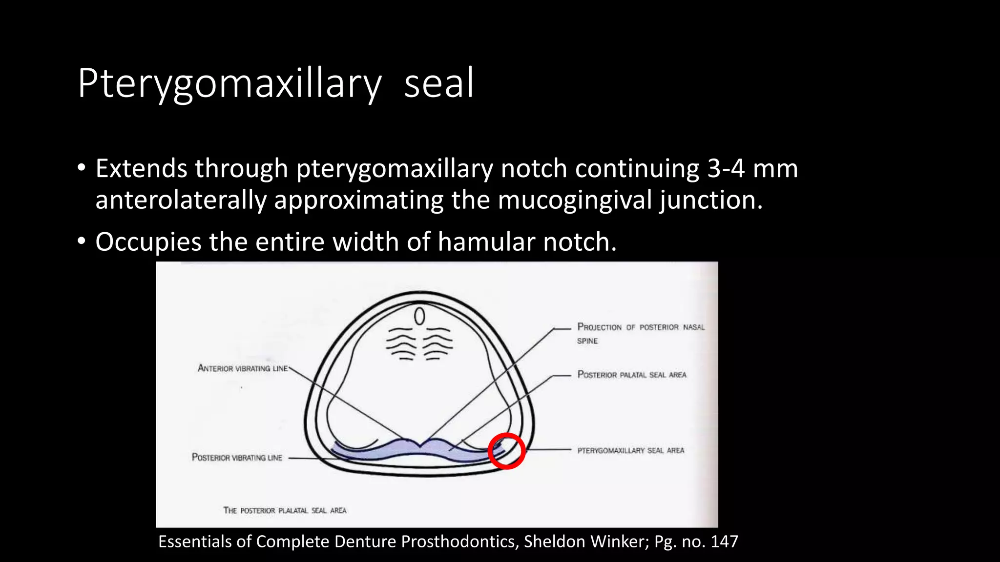Posterior Palatal Seal | PPTX