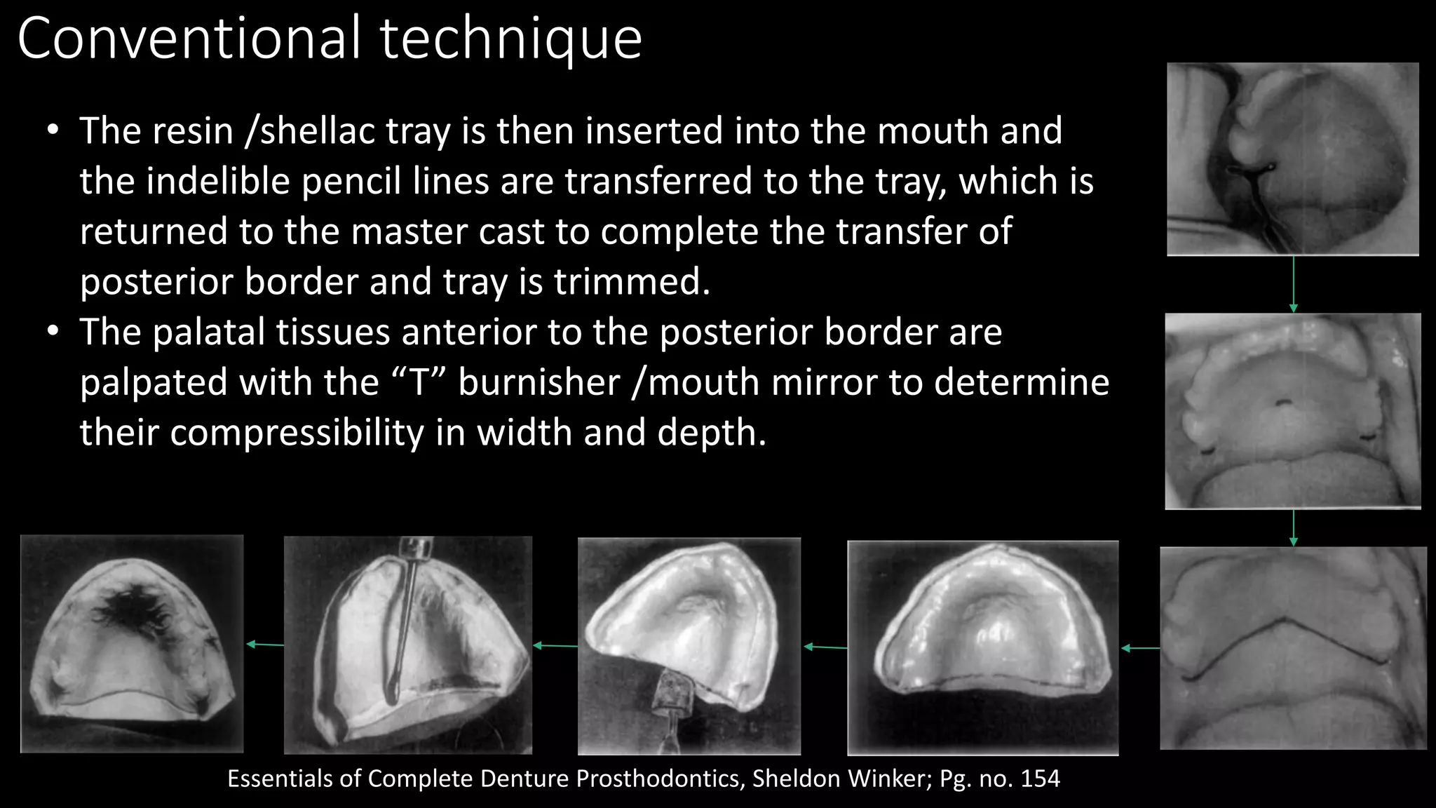 Posterior Palatal Seal | PPTX