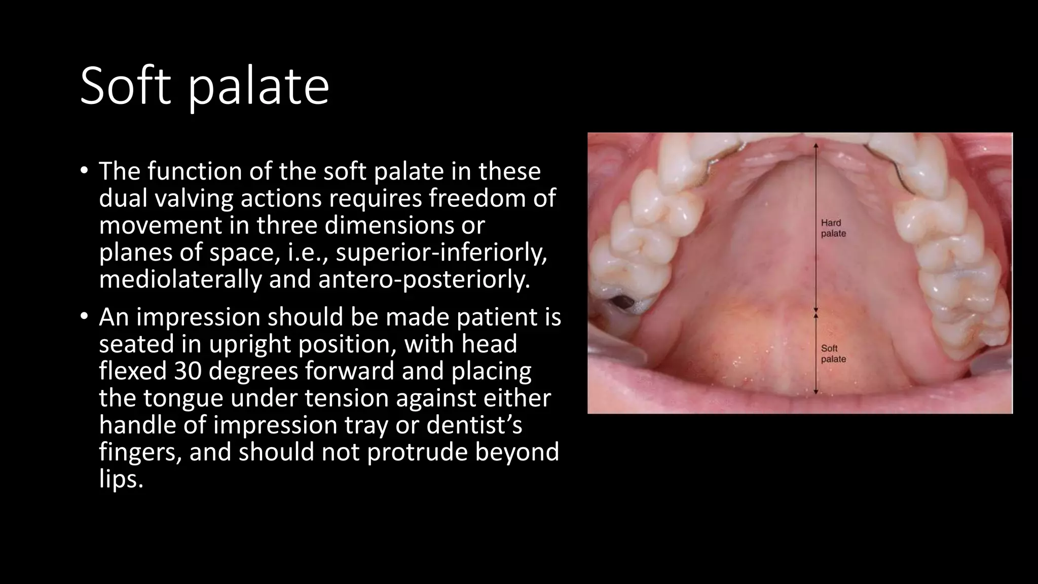 Posterior Palatal Seal | PPTX