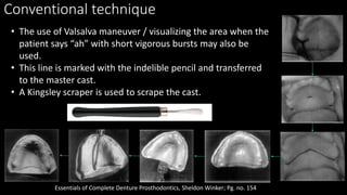 Posterior Palatal Seal | PPTX