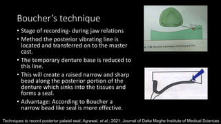 Posterior Palatal Seal | PPTX