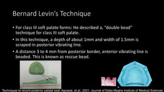 Posterior Palatal Seal | PPTX