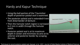 Posterior Palatal Seal | PPTX