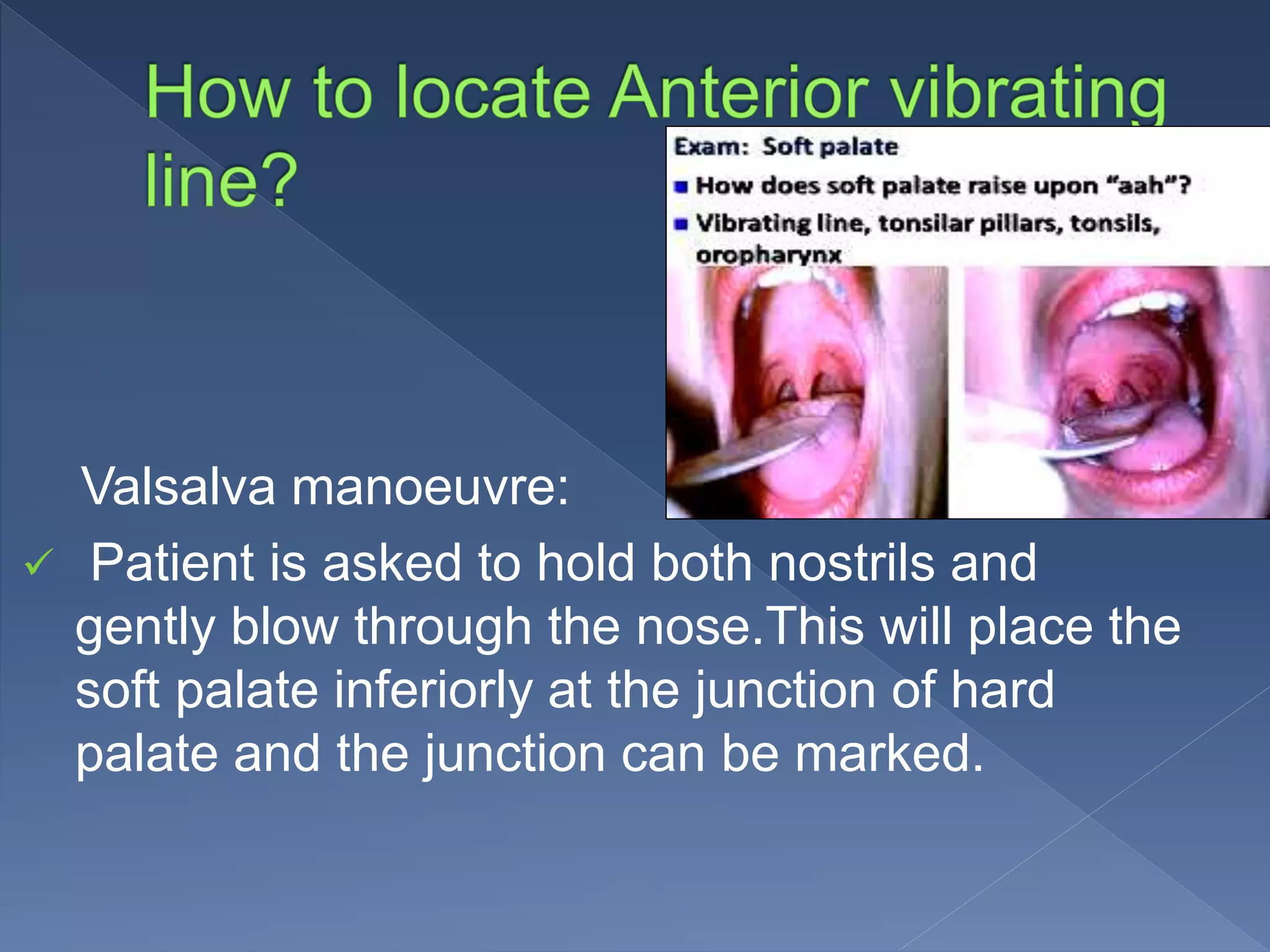 POSTERIOR PALATAL SEAL AREA.pptx