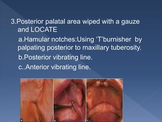 POSTERIOR PALATAL SEAL AREA.pptx
