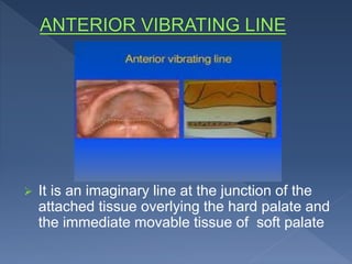 POSTERIOR PALATAL SEAL AREA.pptx