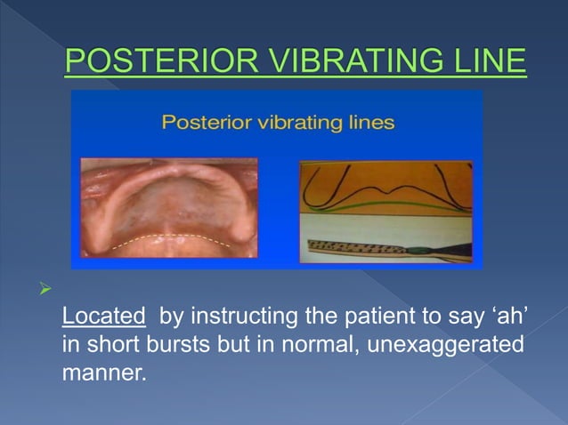 POSTERIOR PALATAL SEAL AREA.pptx
