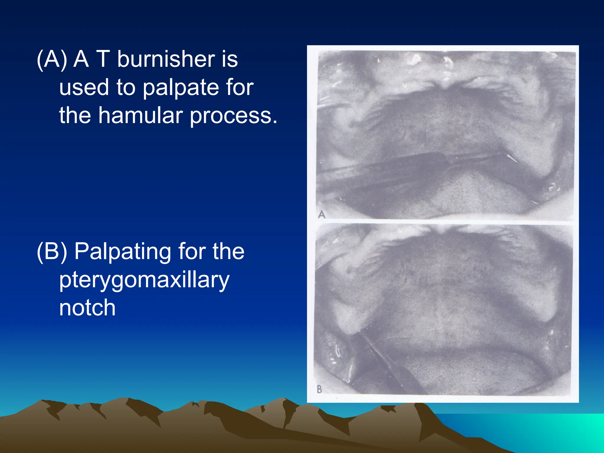 POSTERIOR_PALATAL_SEAL ppt PROSTHODONTICS | PPT