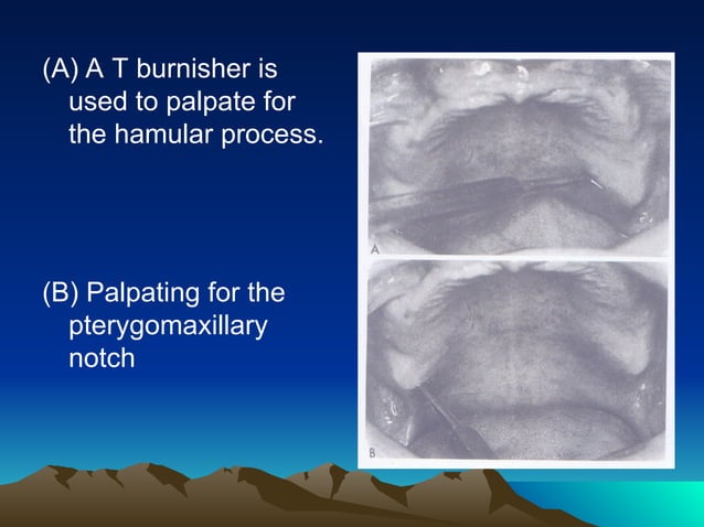 POSTERIOR_PALATAL_SEAL ppt PROSTHODONTICS | PPT