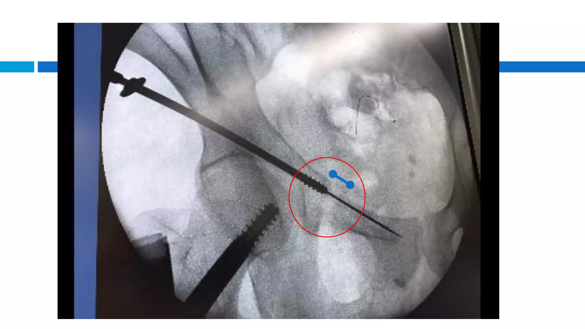 Posterior pelvic ring injury | PPT