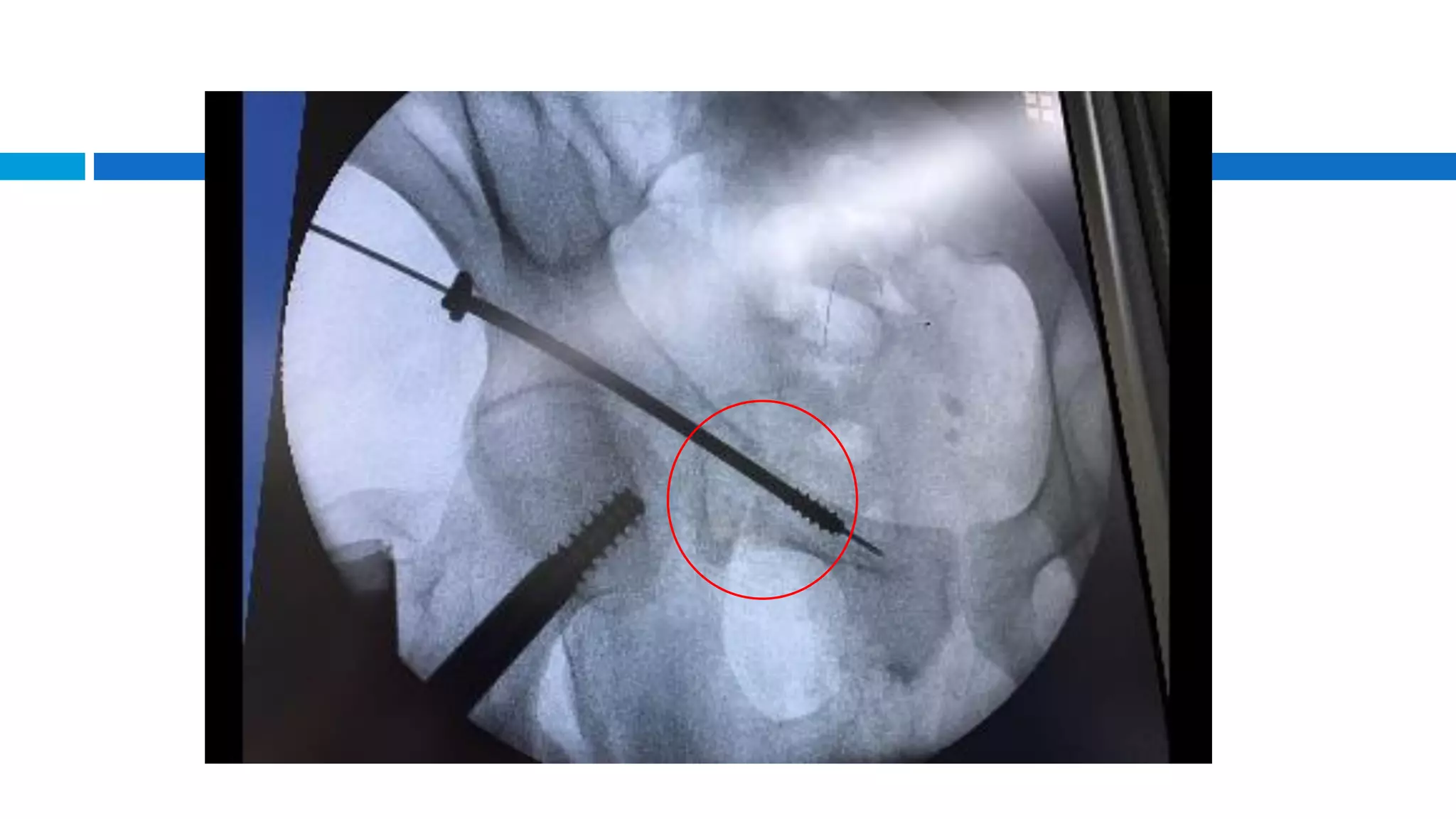 Posterior pelvic ring injury | PPT