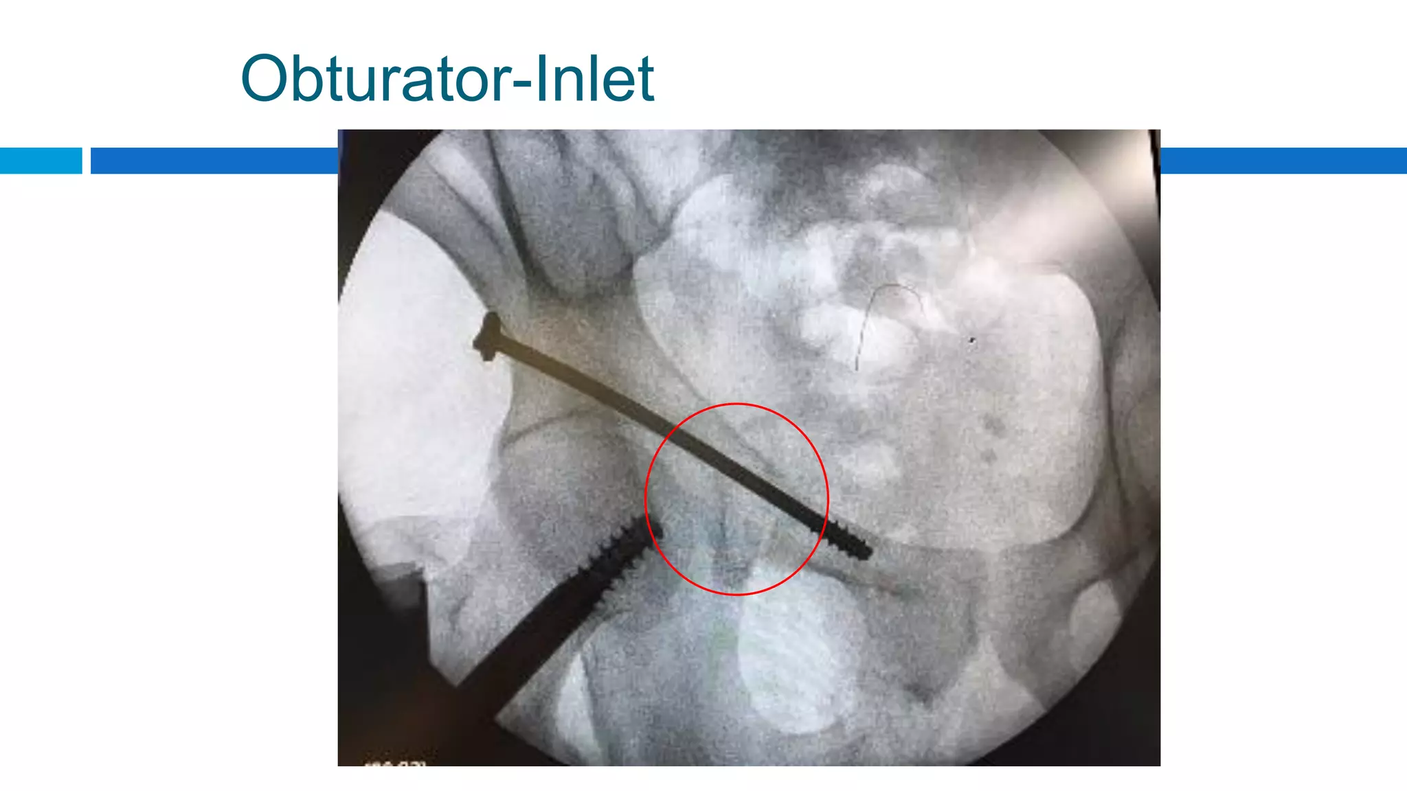 Posterior pelvic ring injury | PPT