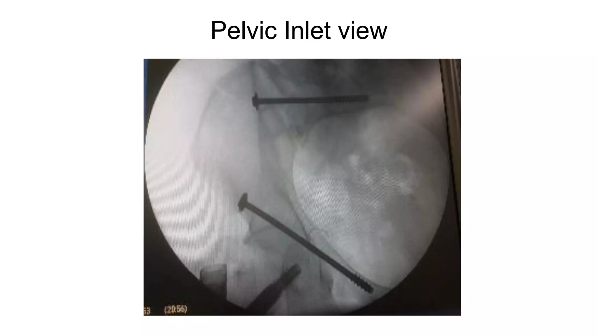 Posterior pelvic ring injury | PPT