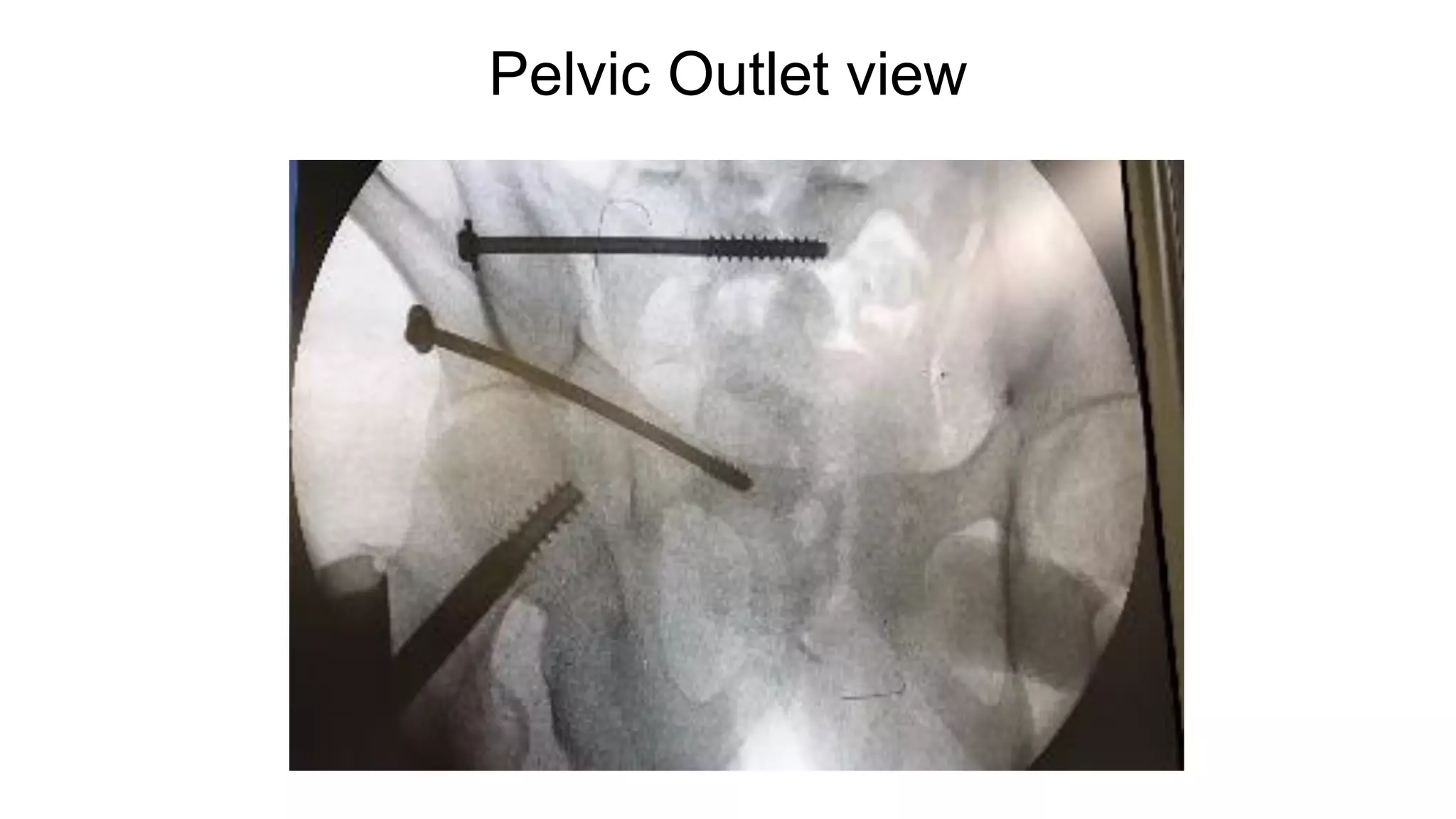 Posterior pelvic ring injury | PPT