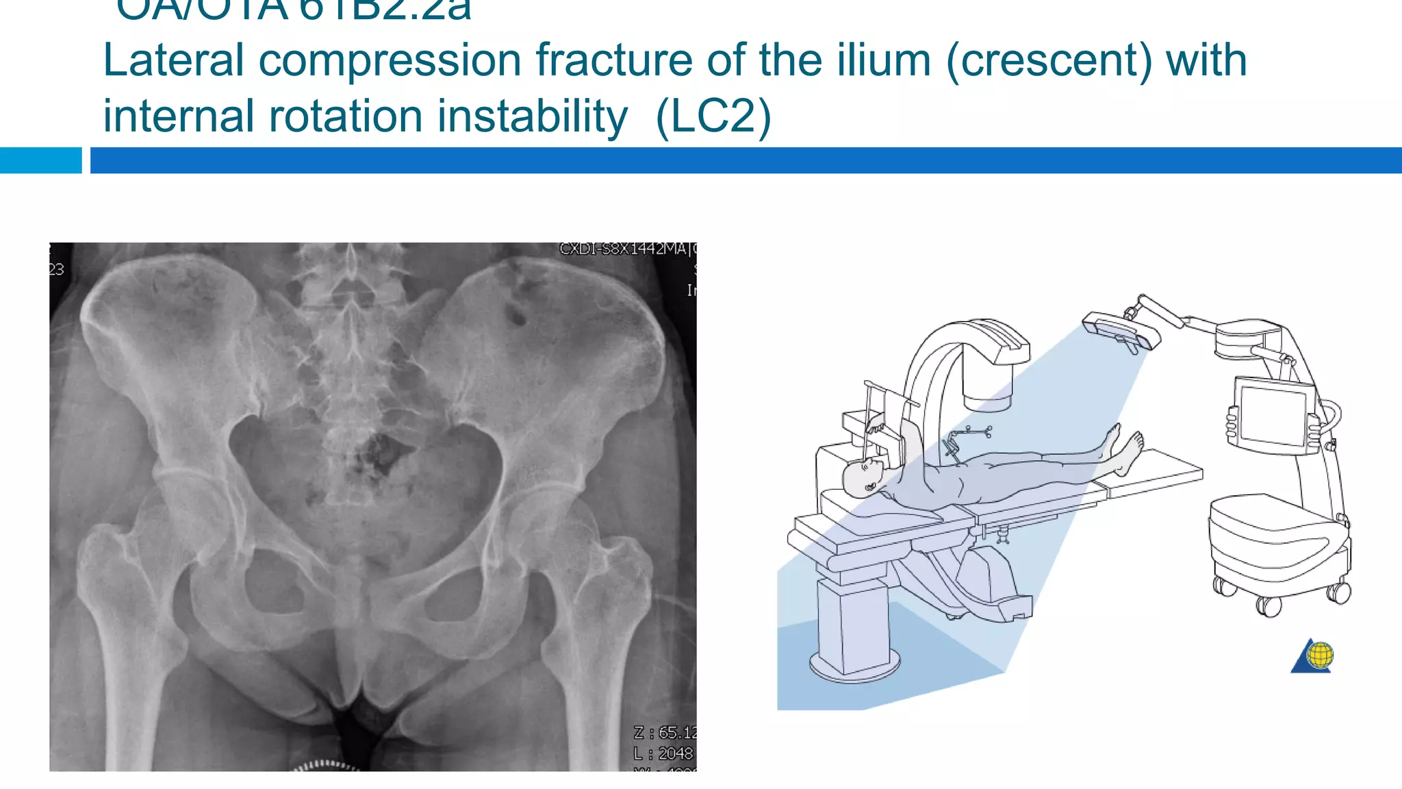 Posterior pelvic ring injury | PPT