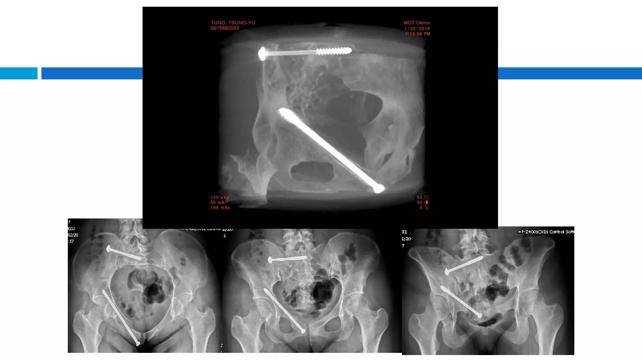 Posterior pelvic ring injury | PPT
