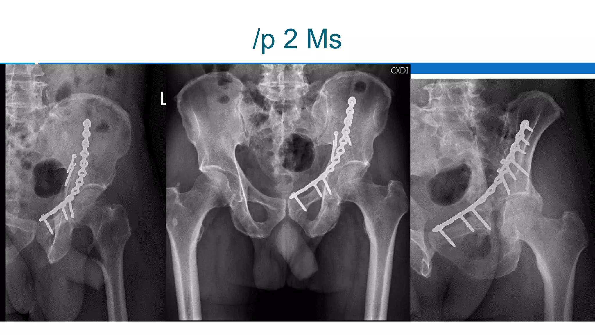 Posterior pelvic ring injury | PPT