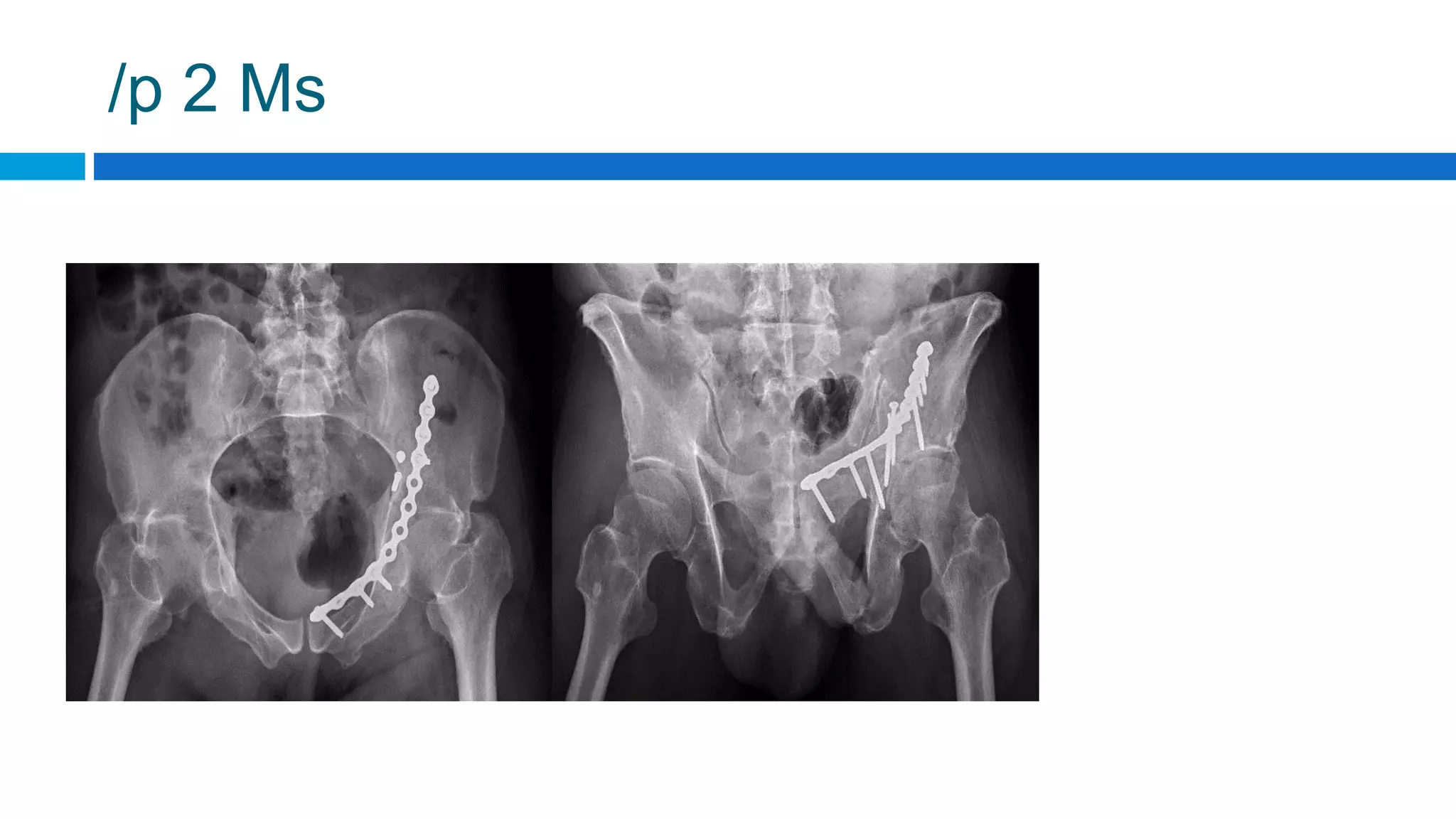 Posterior pelvic ring injury | PPT
