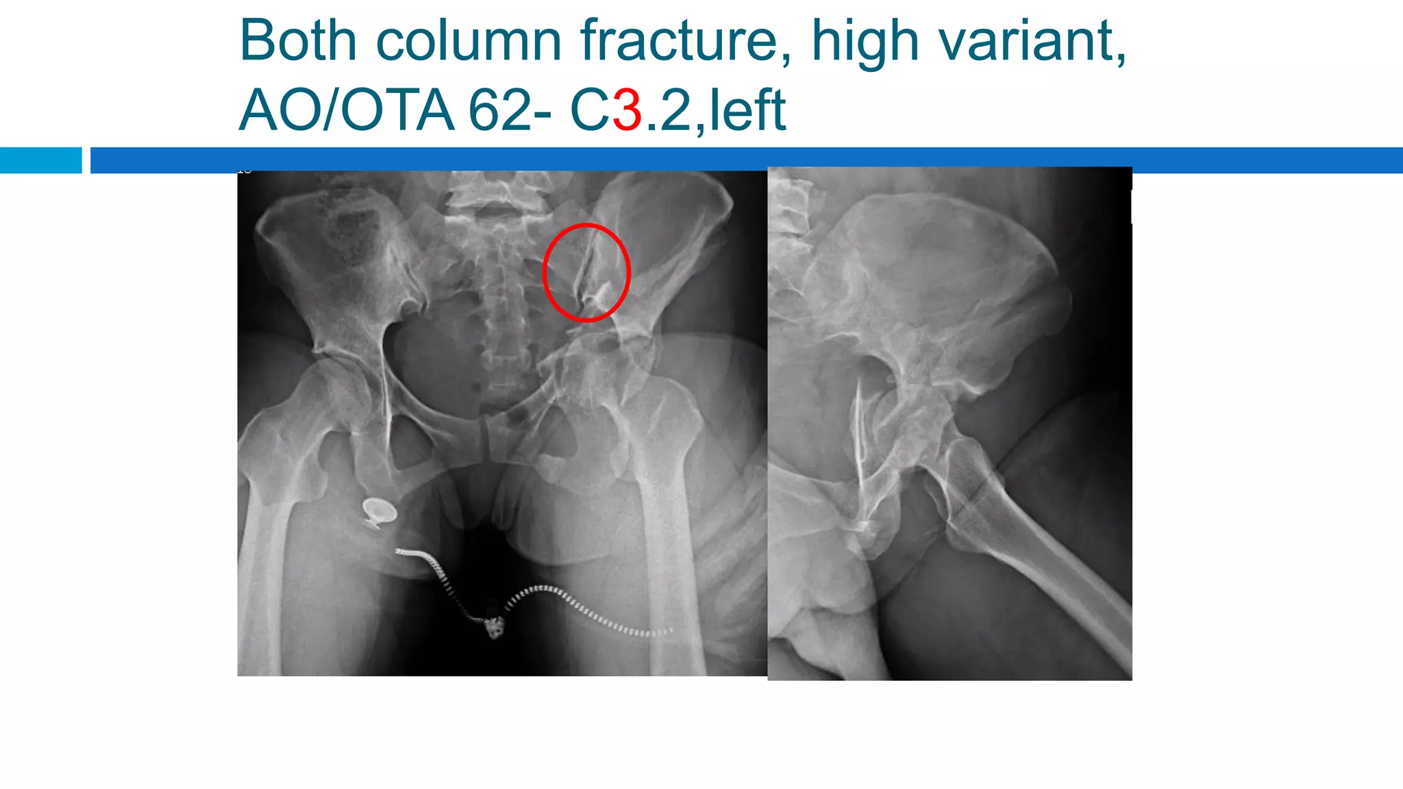 Posterior pelvic ring injury | PPT