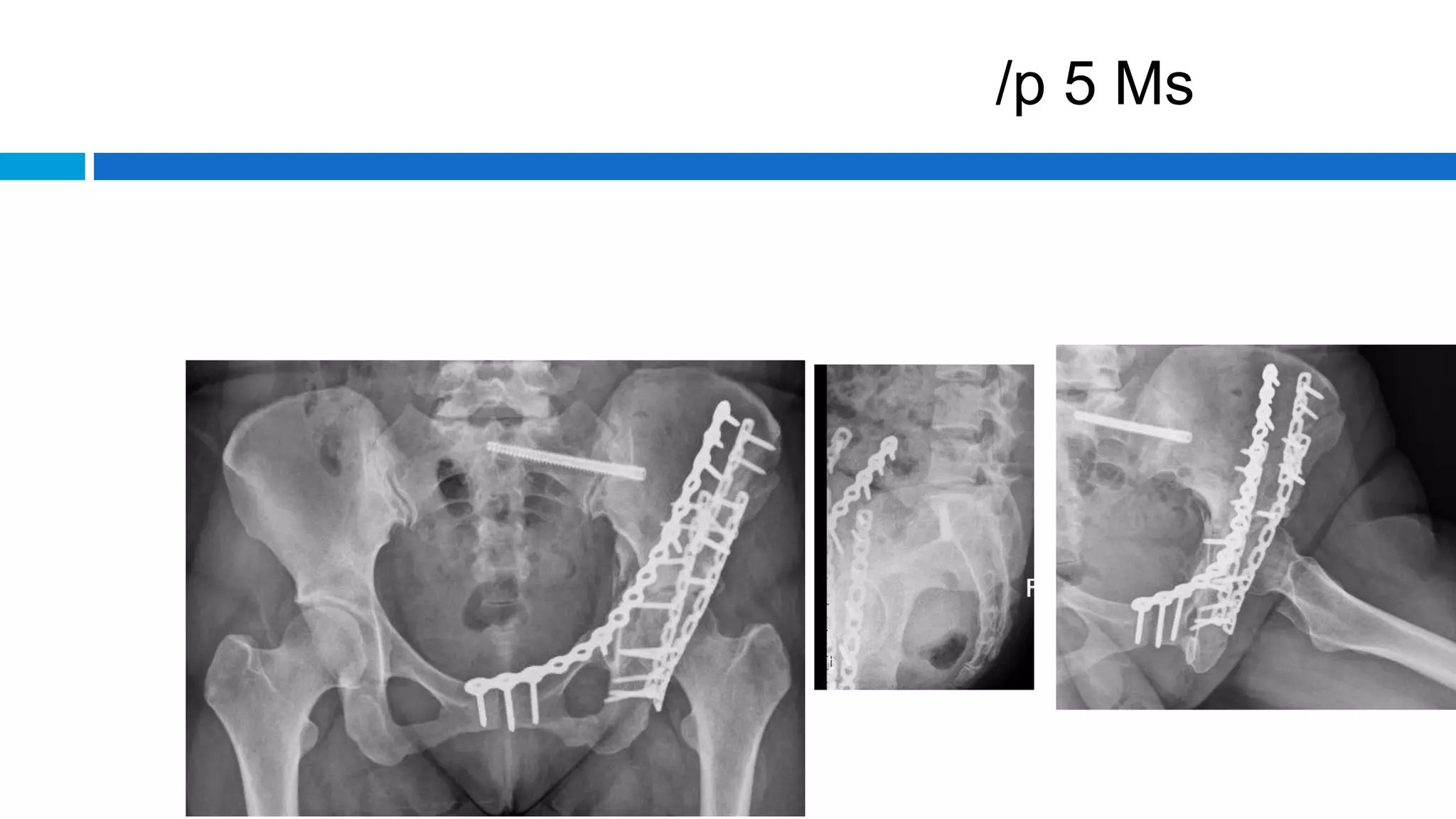 Posterior pelvic ring injury | PPT
