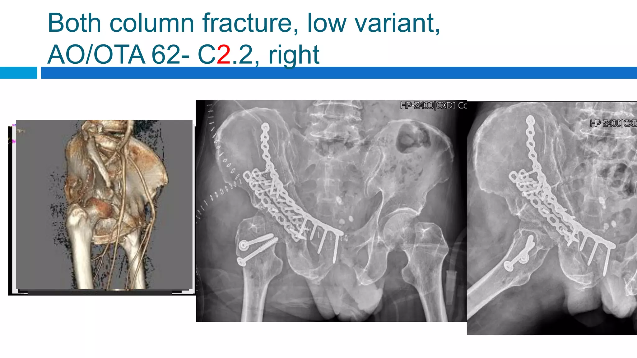 Posterior pelvic ring injury | PPT