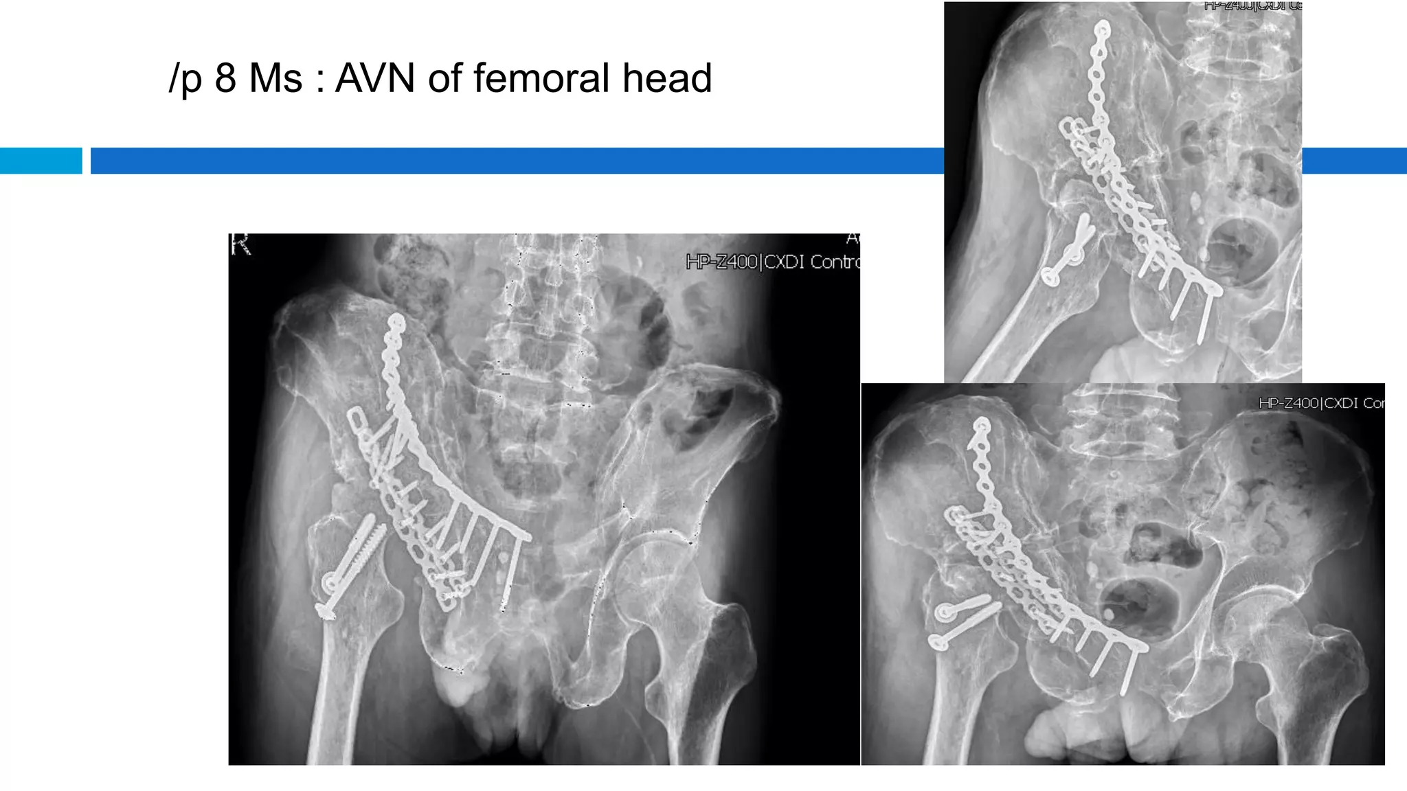 Posterior pelvic ring injury | PPT