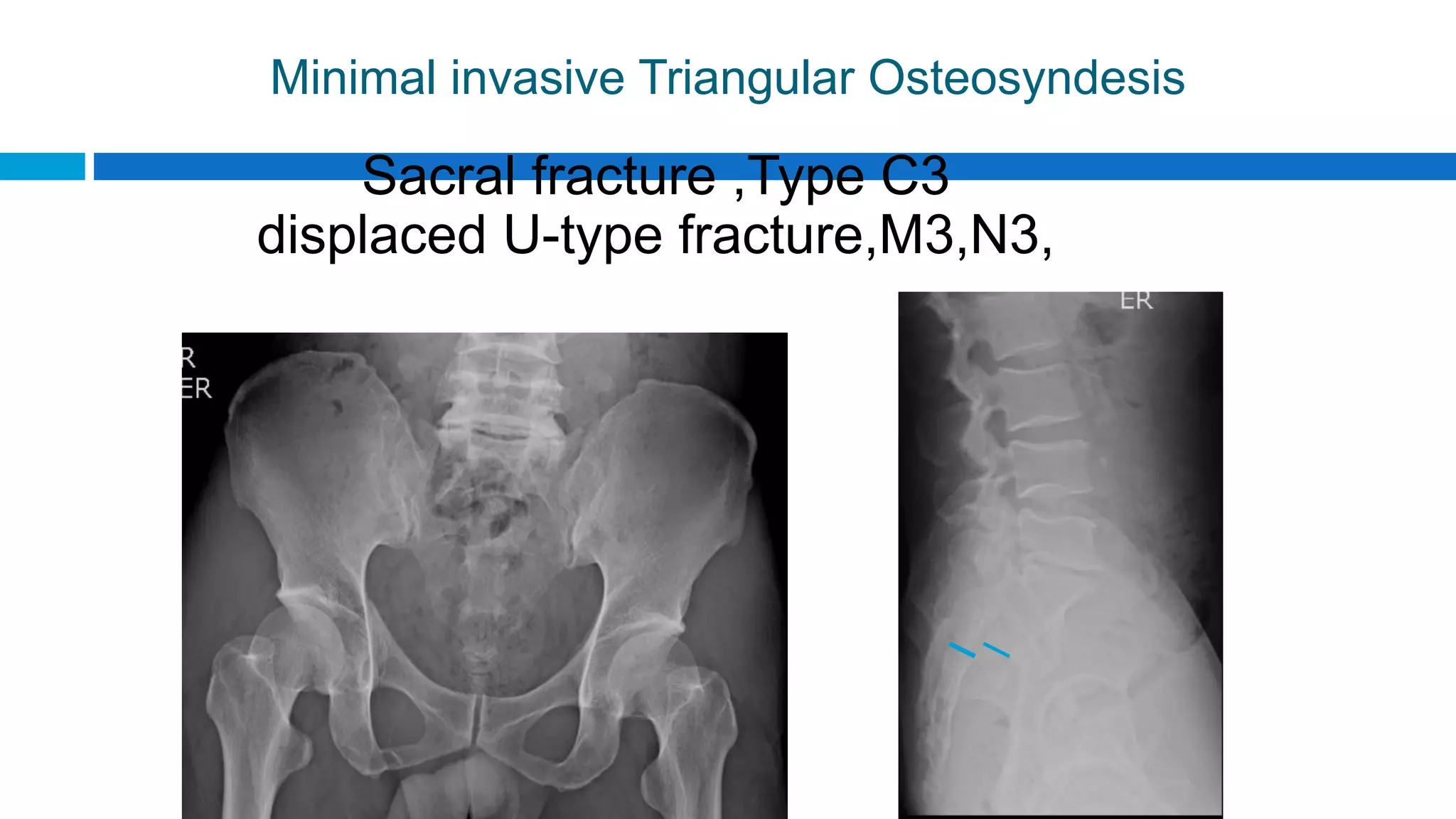Posterior pelvic ring injury | PPT