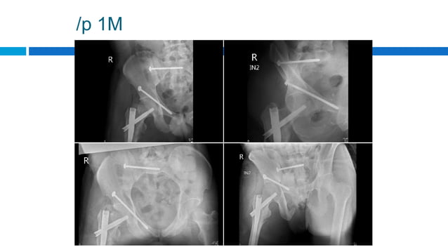 Posterior pelvic ring injury | PPT