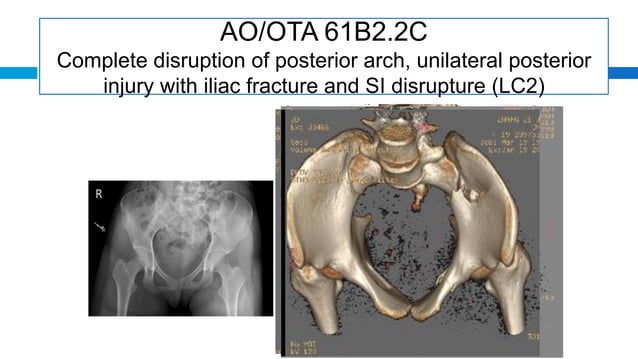 Posterior pelvic ring injury | PPT