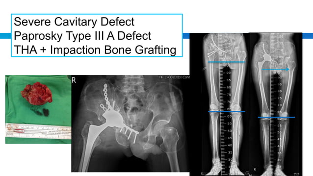 Posterior pelvic ring injury | PPT