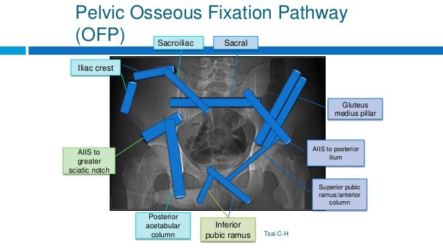 Posterior pelvic ring injury