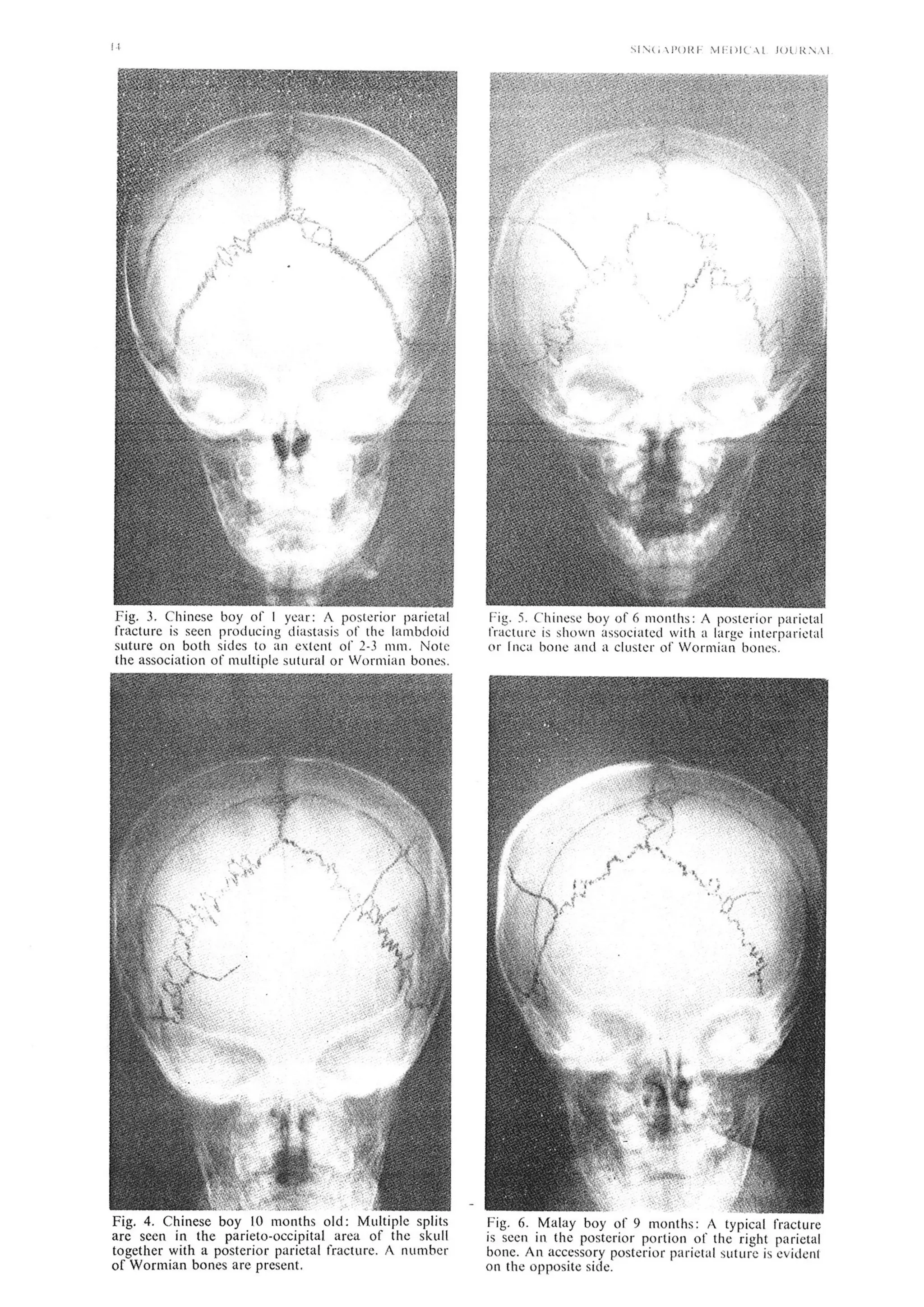 Posterior Periatel Fractures In Infancy | PDF