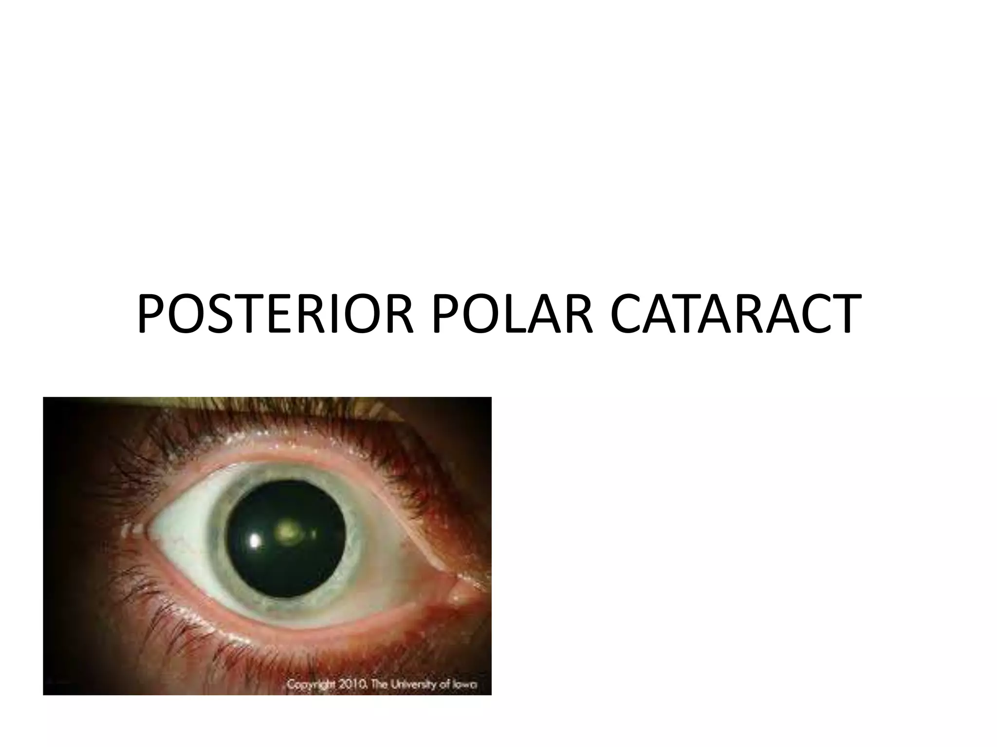 Posterior polar cataract | PPTX