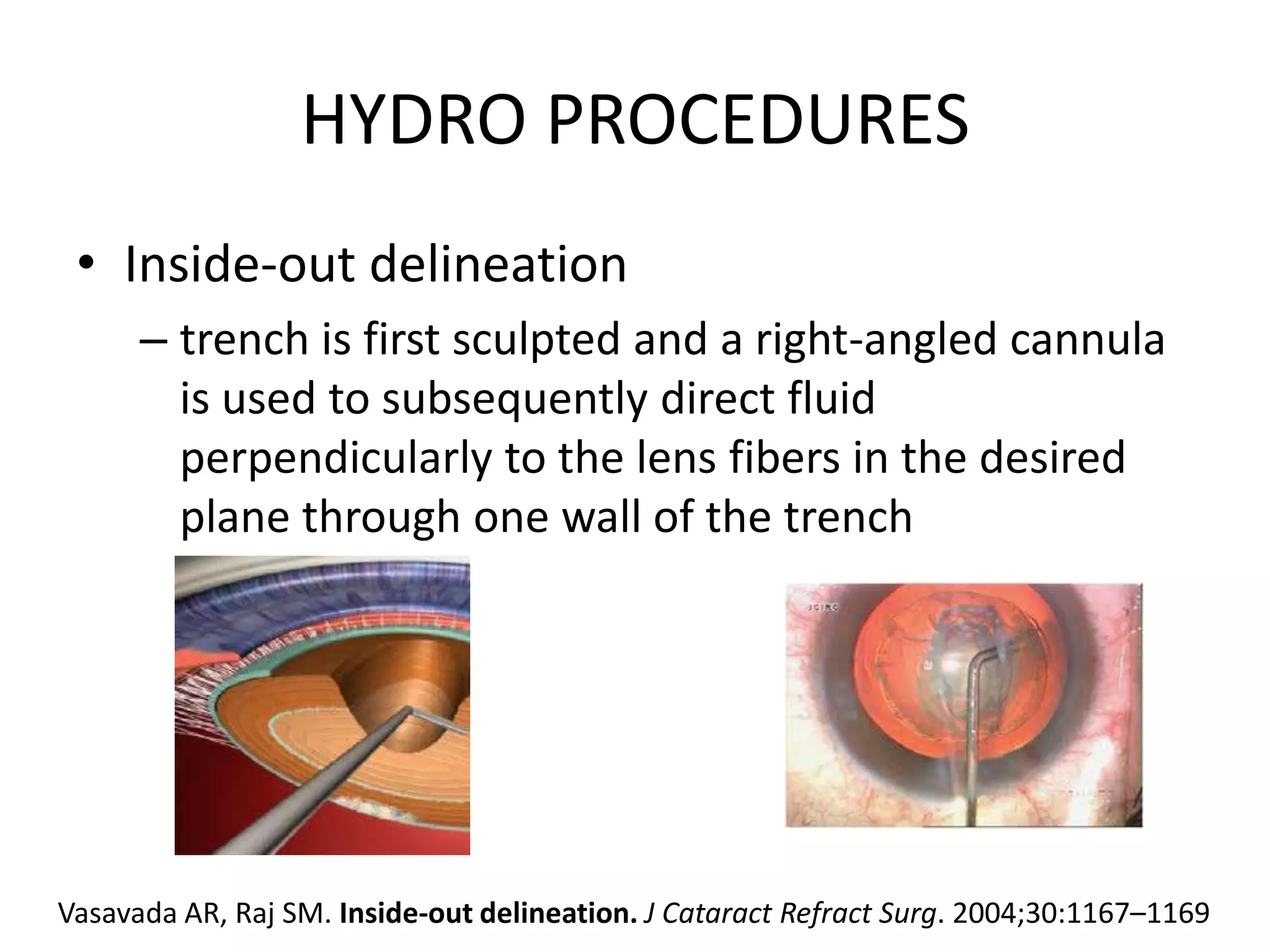 Posterior polar cataract | PPTX