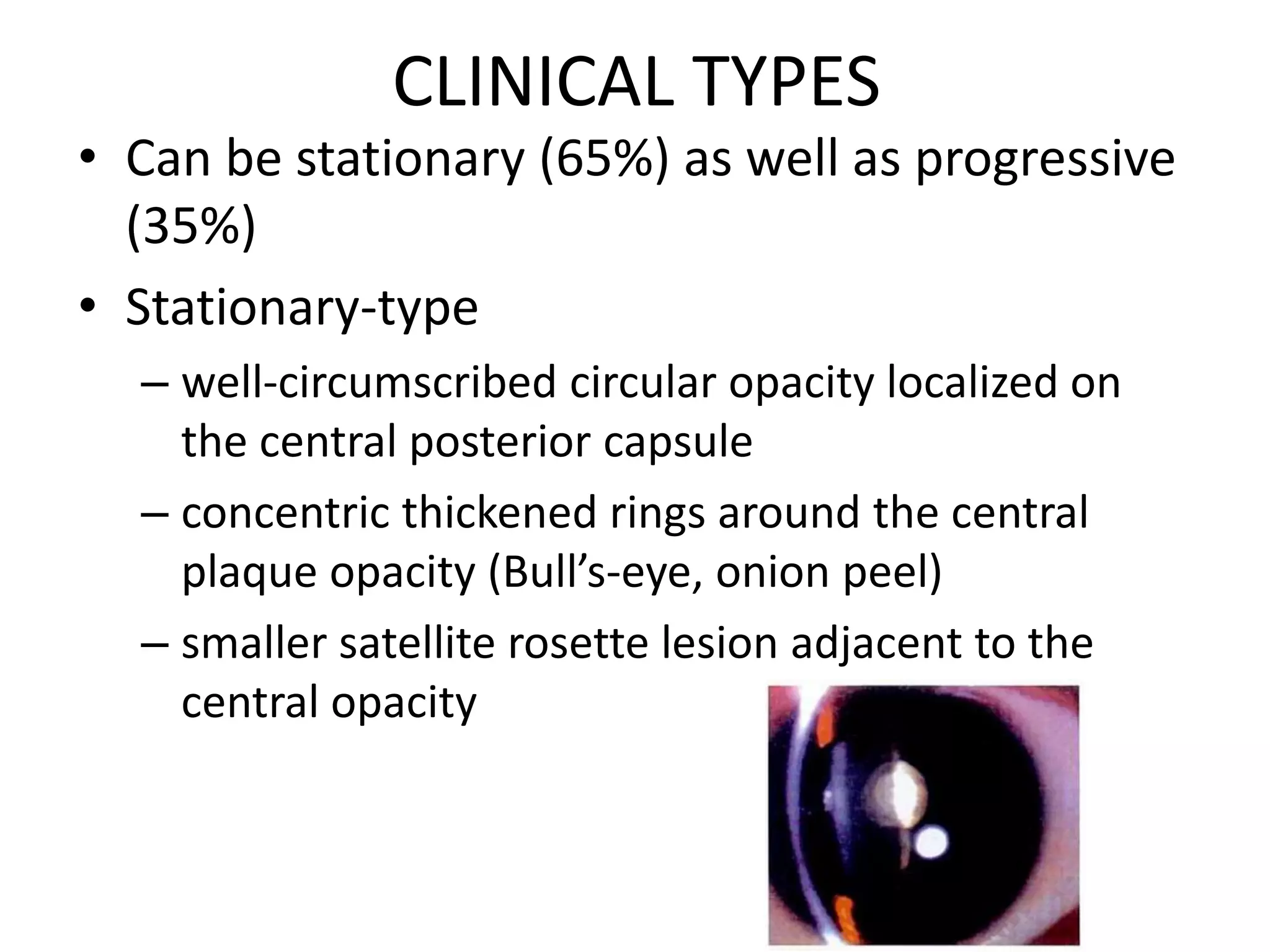 Posterior polar cataract | PPTX