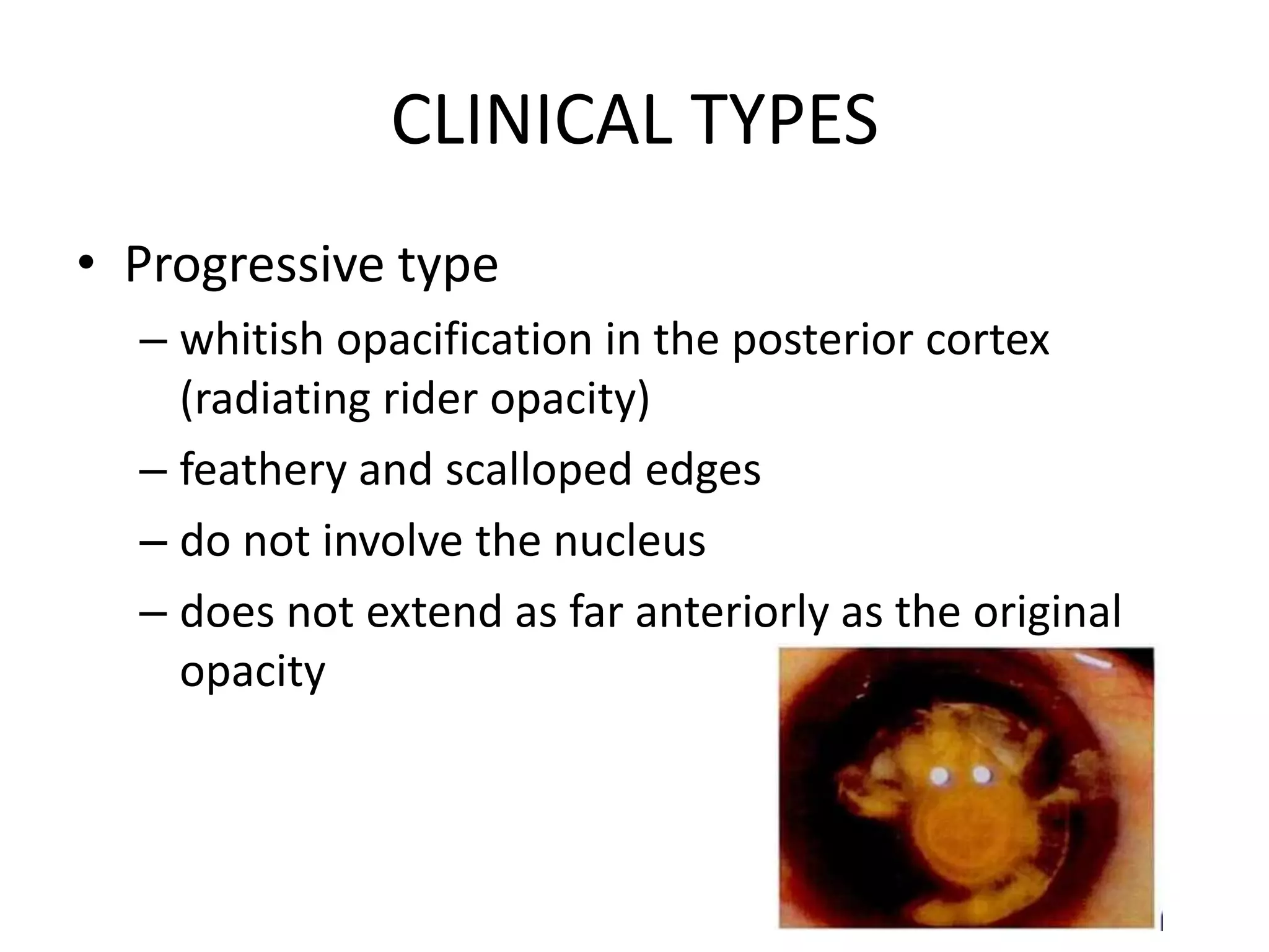 Posterior polar cataract | PPTX