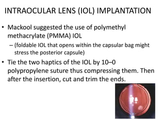 Posterior polar cataract | PPTX