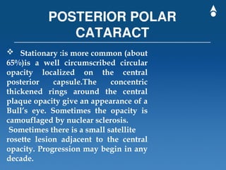 Posterior Polar Cataract PPC in the posterior cortex | PPT