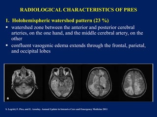 Posterior reversible encephalopathy syndrome | PPTX