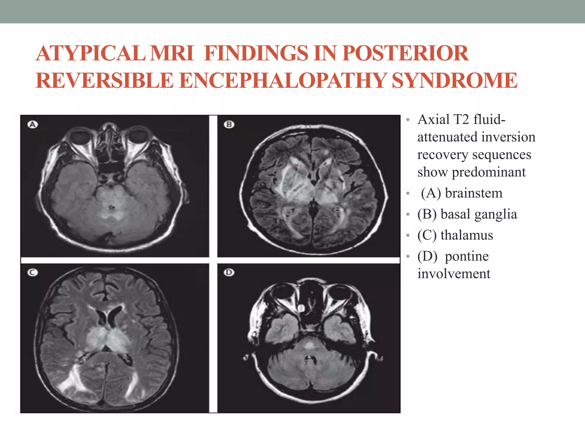 Posterior reversible encephalopathy syndrome | PPTX