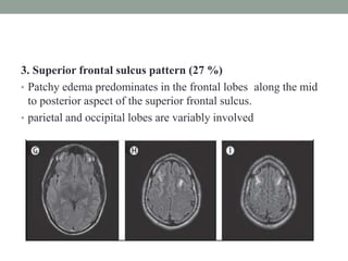 Typical Presentation Of Posterior Reversible