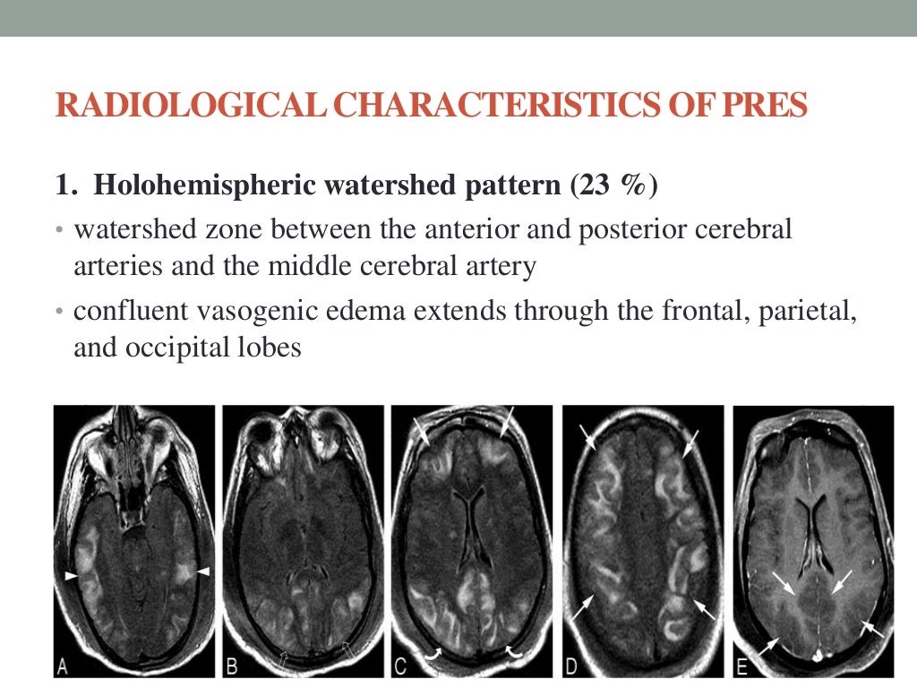 Posterior Reversible Encephalopathy Syndrome