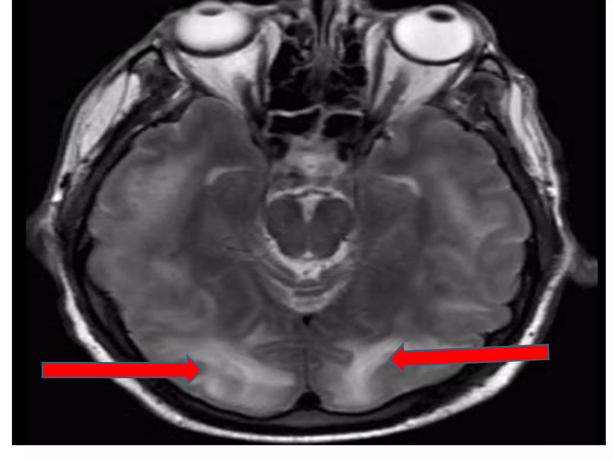Posterior reversible encephalopathy syndrome | PPTX