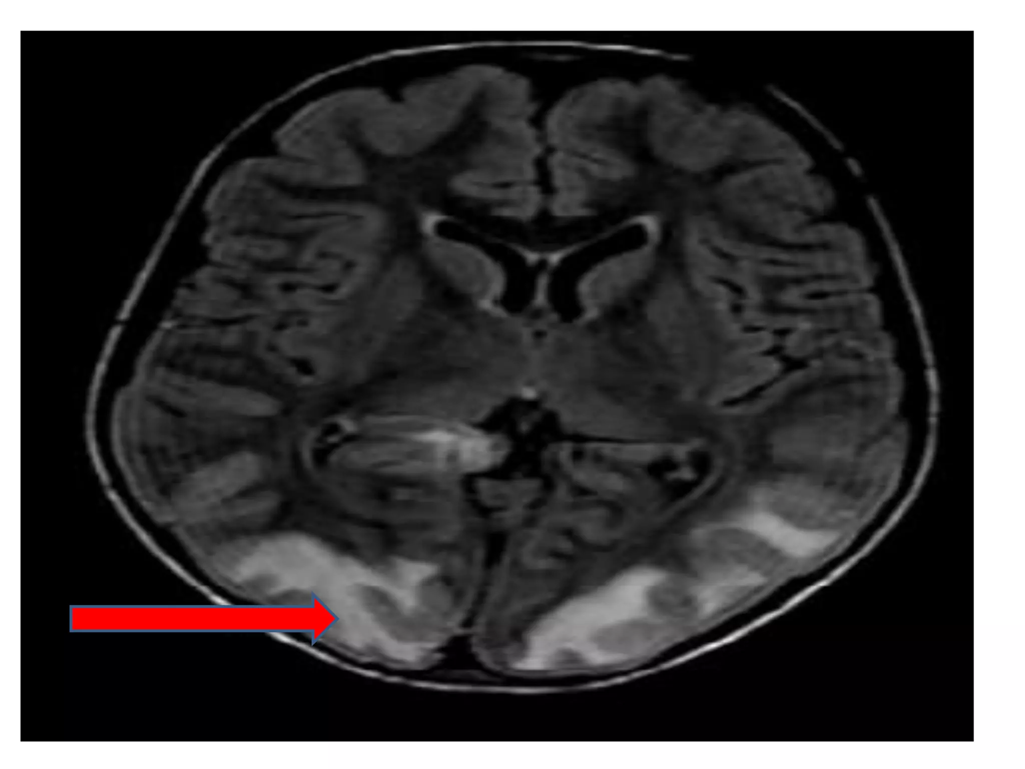 Posterior reversible encephalopathy syndrome | PPTX