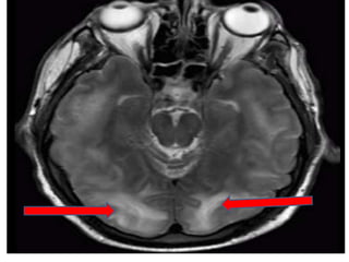 Posterior reversible encephalopathy syndrome | PPT