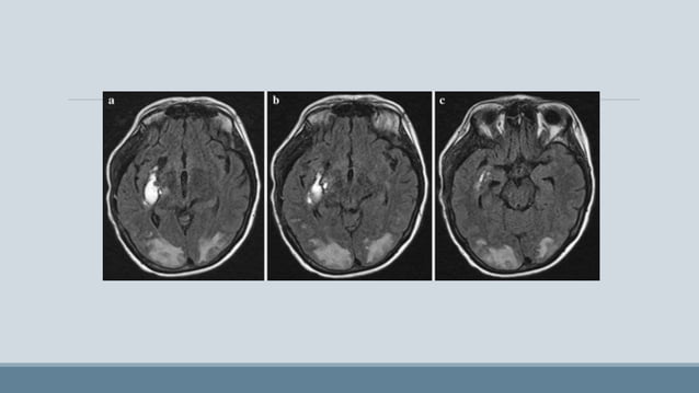 Posterior Reversible Encephalopathy Syndrome | PPT