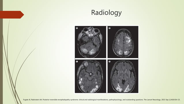 Posterior Reversible Encephalopathy Syndrome | PPTX | Brain and Nervous ...