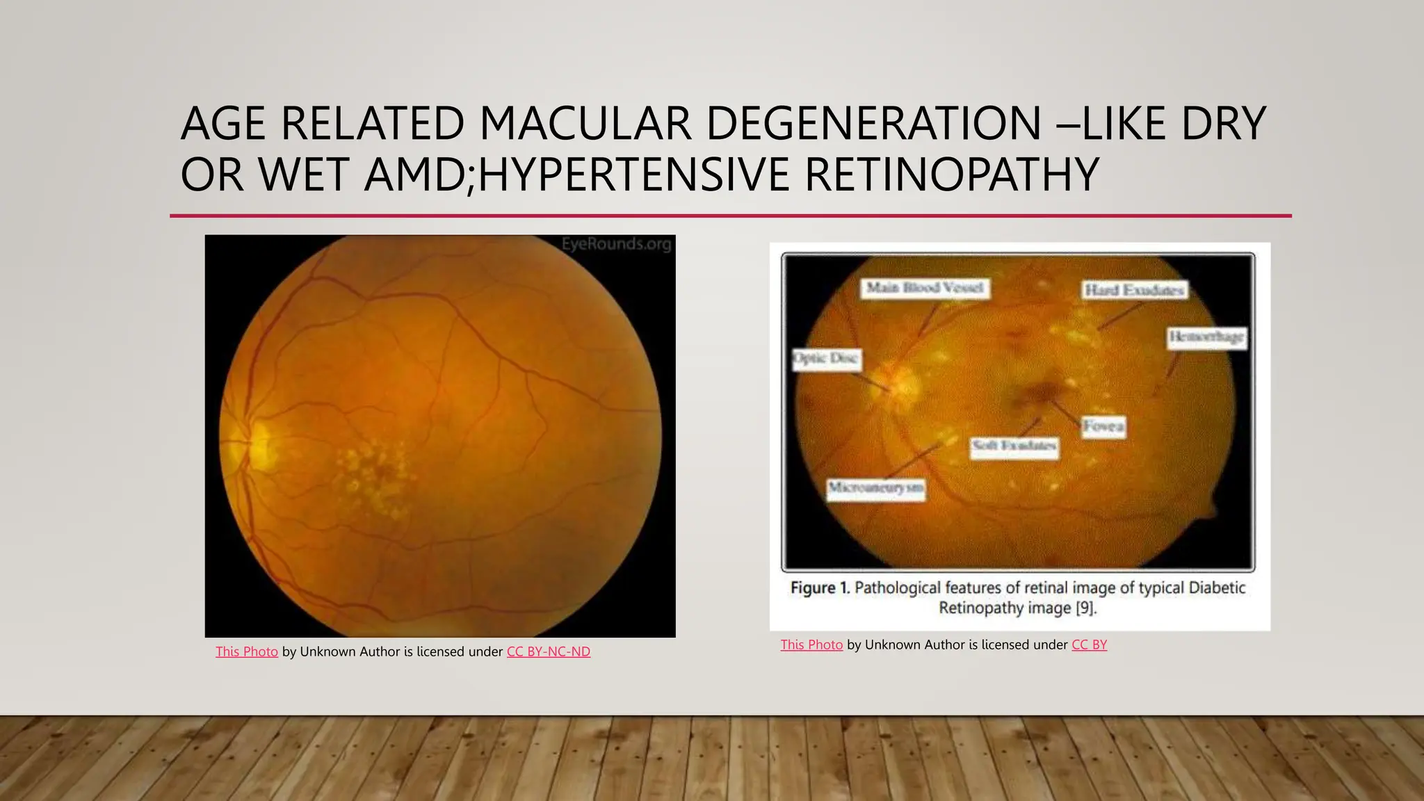 POSTERIOR SEGMENT EXAMINATION OF EYE.pptx