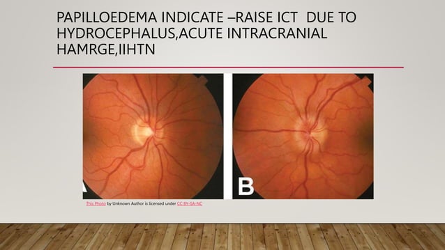POSTERIOR SEGMENT EXAMINATION OF EYE.pptx | Eye and Vision Conditions ...